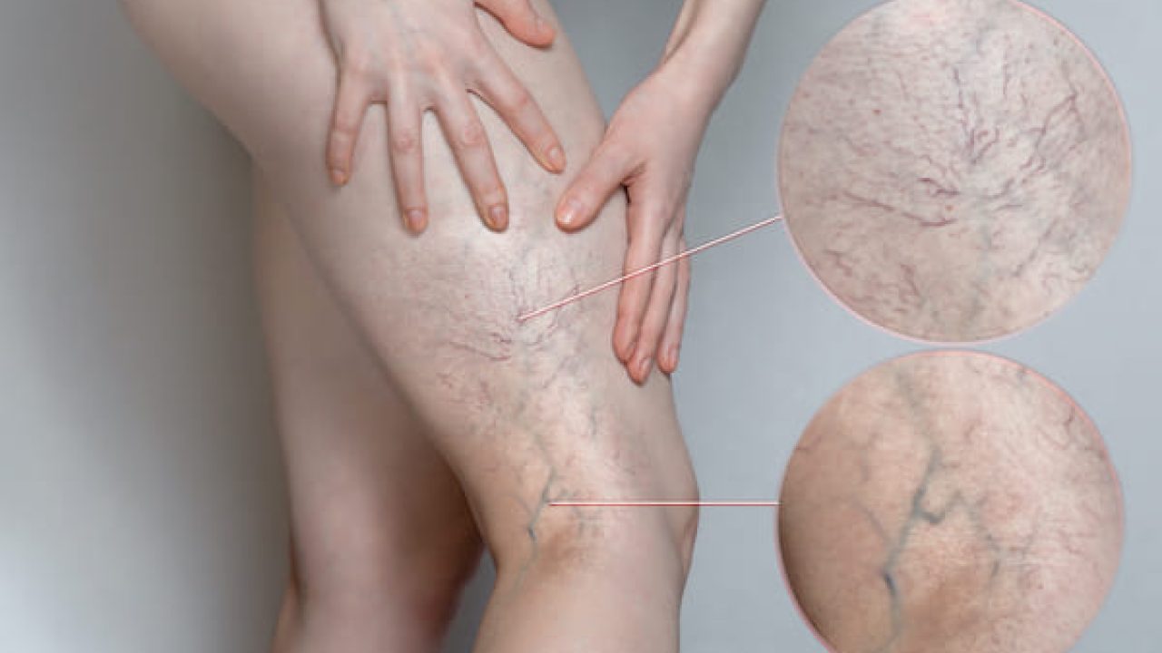 Varicose Veins Mmra