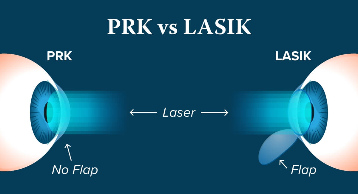 पीआरके उपचार (PRK Treatment): प्रक्रिया, फायदे और उपचार