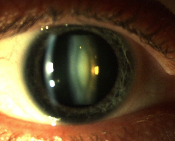 Nuclear Cataracts: Risks, Diagnosis, Treatment And Prevention
