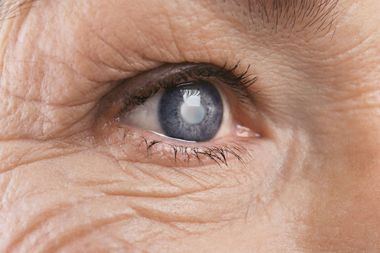 Intumescent Cataracts: Symptoms, Causes And Treatment