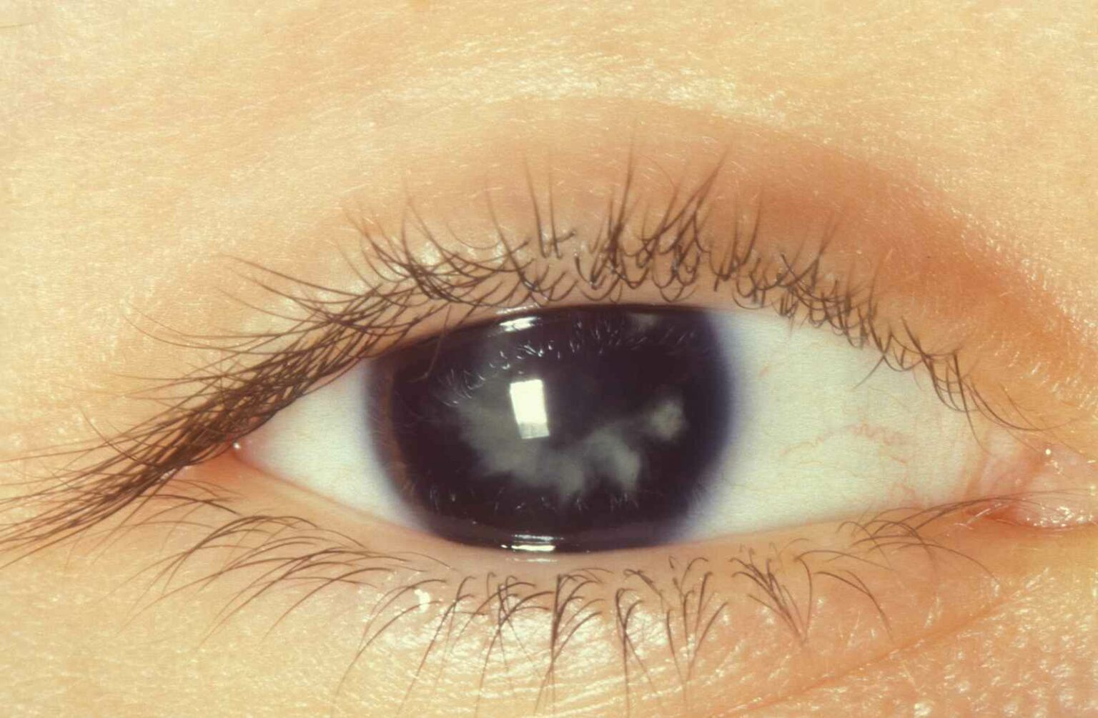 Secondary Cataract: Meaning, Causes, Diagnosis And Prevention