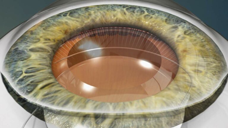 Extracapsular Cataract Extraction: Procedure, Benefits, Risks