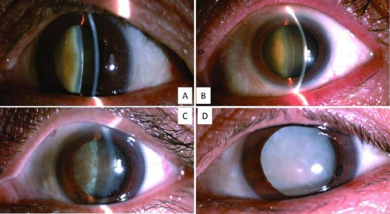Immature Cataract- How It Is Treated?