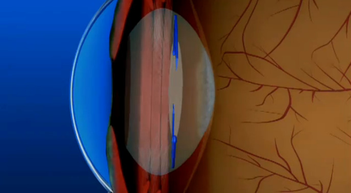 Lamellar Cataract- How It Is Treated And Prevented?