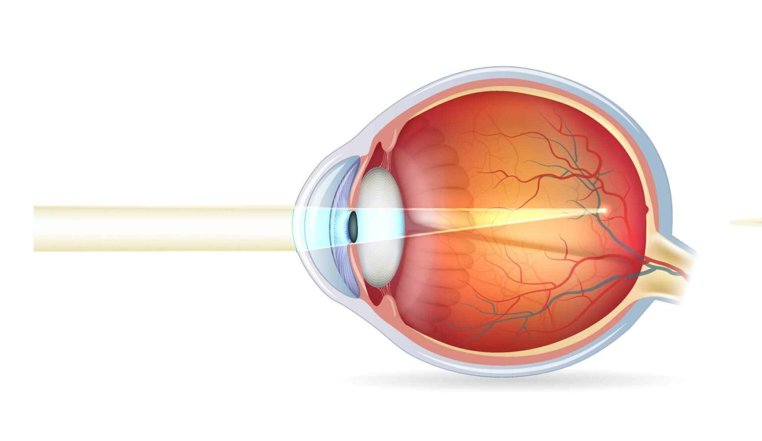 Myopia Correction Surgery: A Complete Guide